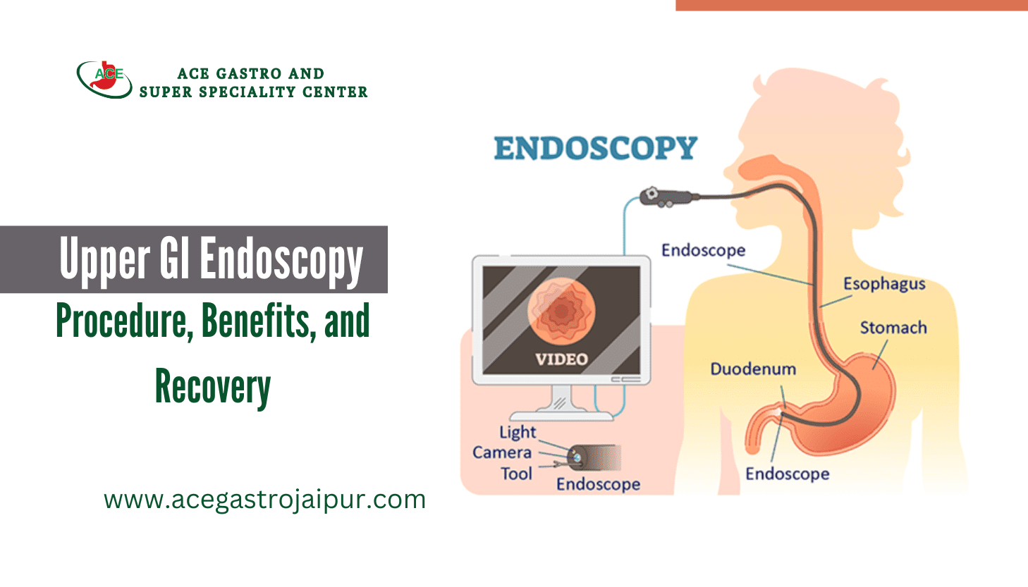 What is Upper GI Endoscopy: Procedure, Benefits, and Recovery | ACE Gastro